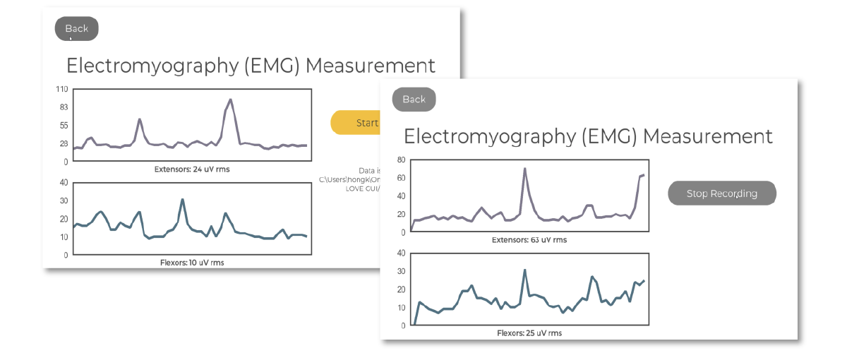 EsoGLOVE™ Myo - Roceso Technologies